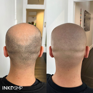 Scalp Micropigmentation Treatment & Training With INKD SMP