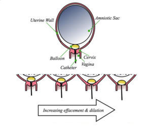 La modélisation et l’impression 3D pour mieux comprendre la dilatation ...