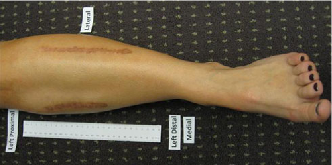 Chronic Compartment Syndrome - Common in Runners