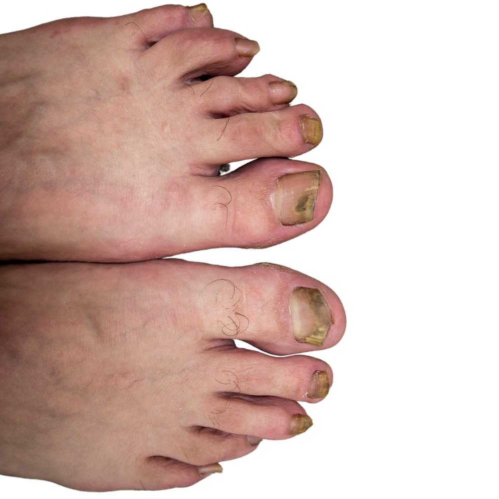 How to cure a fungal toenail infection
