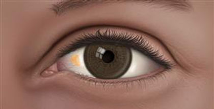 Pinguecula and Pterygium | BayEyeCareInstitute