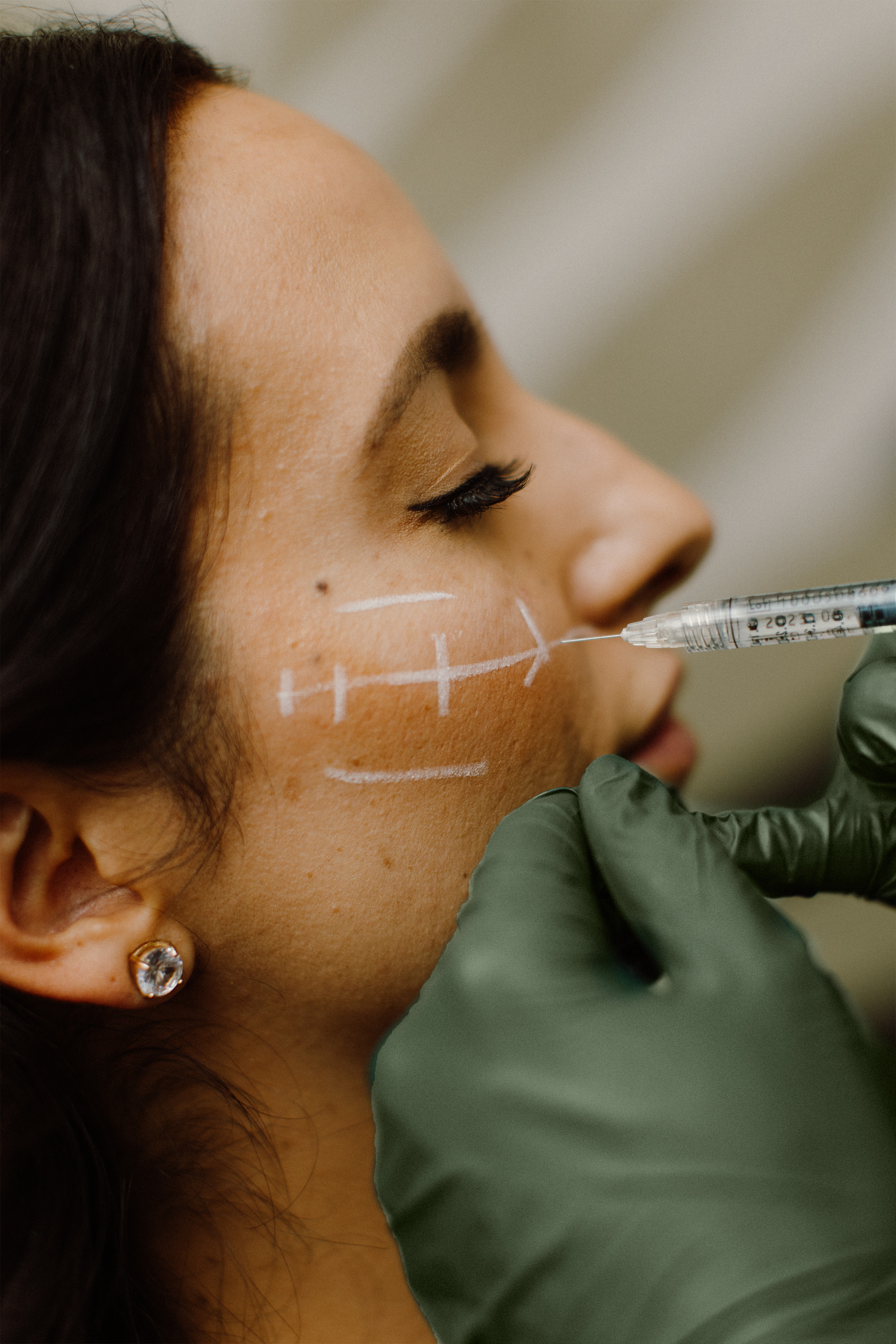 Dermal Fillers | The Peaceful Poppy Med Spa in Longmont, CO | Cheek ...