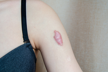 Keloid Treatment | Patient Info | Niagara ENT & Facial Surgery