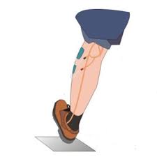 "Revitalizing Mobility: FES and Its Benefits in Foot Drop and Multiple ...
