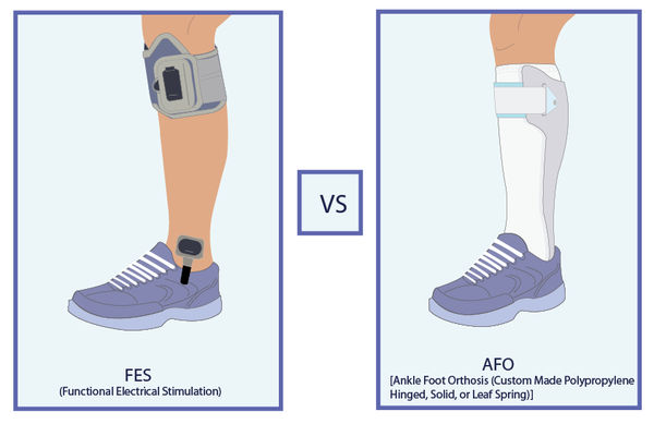 "Revitalizing Mobility: FES and Its Benefits in Foot Drop and Multiple ...