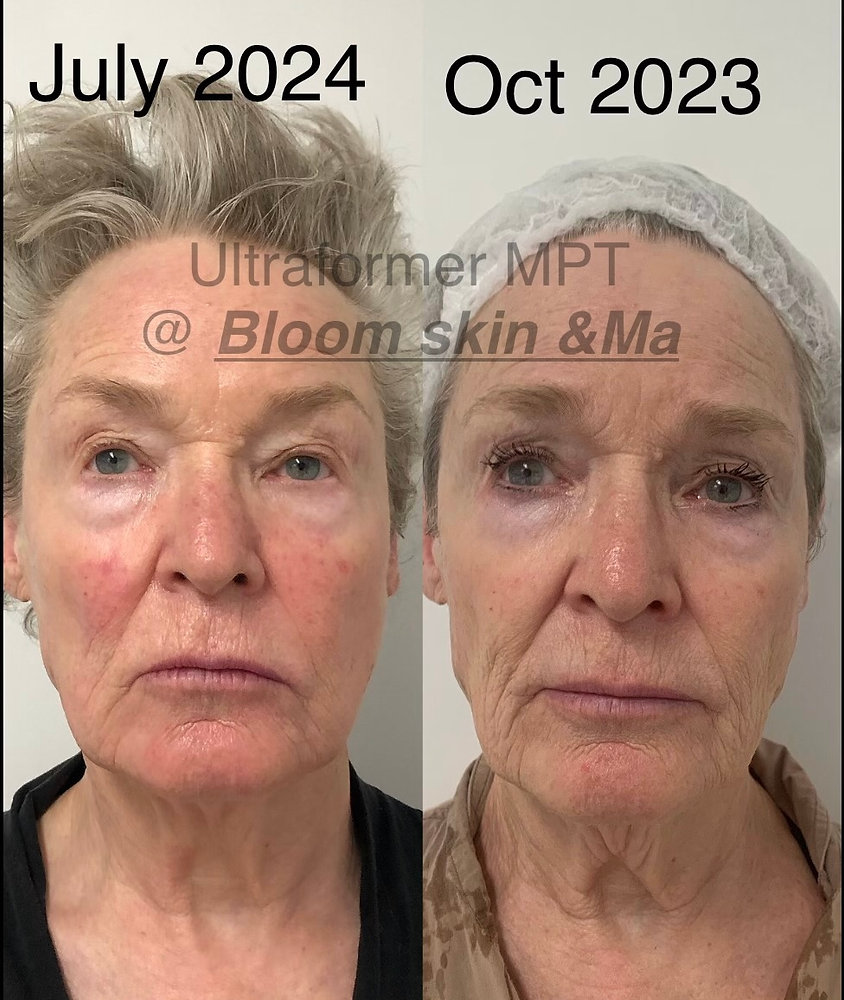 Carol's HIFU Ultraformer MPT results/ face lifting & tightening