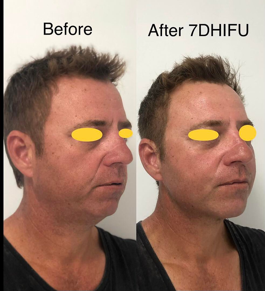 Advantages of 7D HIFU face lifting treatment.