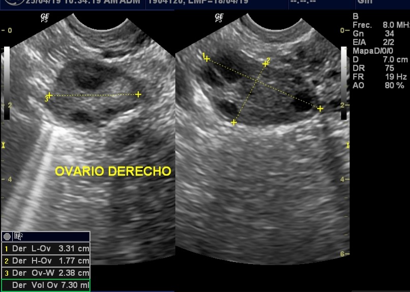 Sinal De Hidromassagem De Ultrassom De Torcao Ovariana