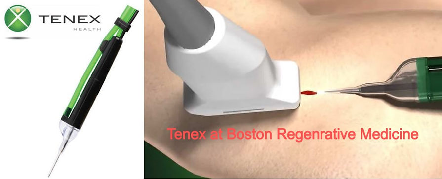 Tenex | N.E. Spine Care