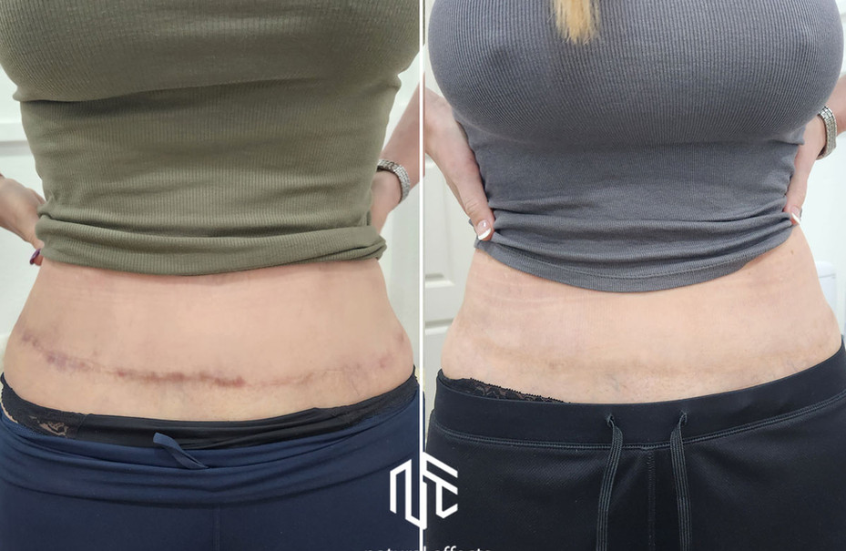 Medical Tattooing Scar Camouflage | Natural Effects Paramedical Tattoos ...