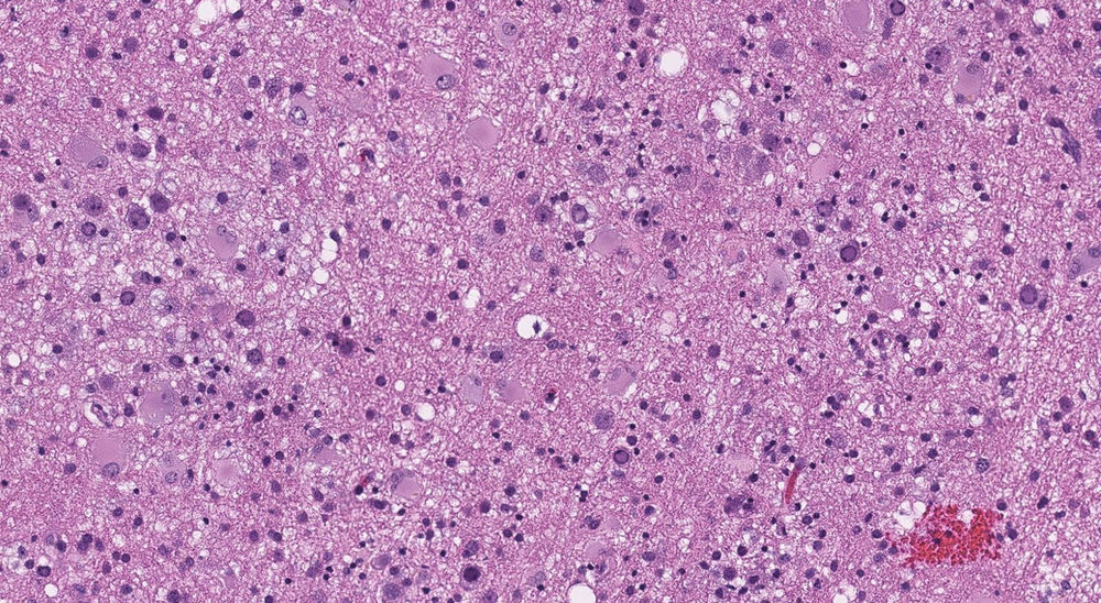 Case # 18 - Plethora of Pathologies
