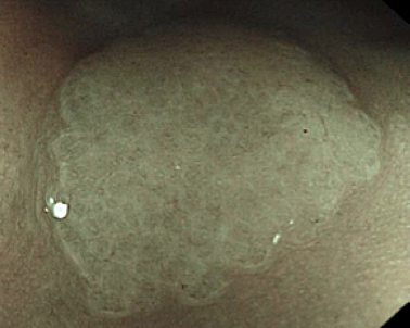 Coloscopie colonoscopy endoscopie