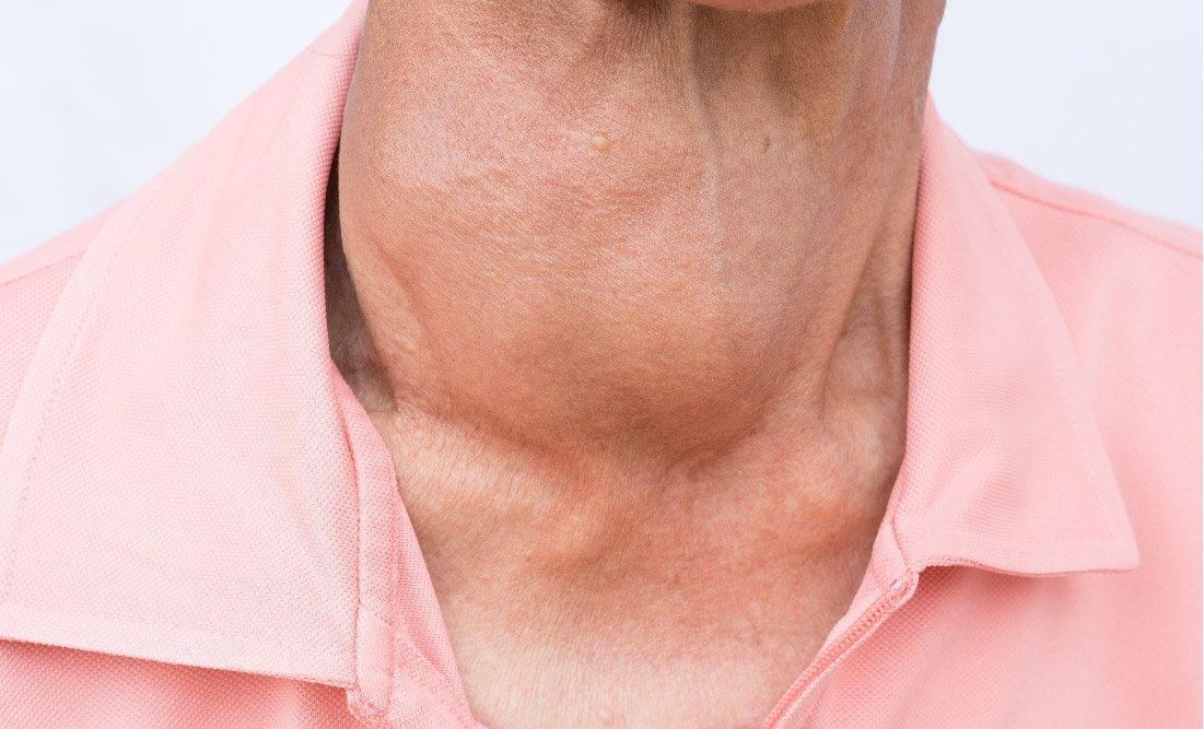 Thyroid Diseases (Goiter)