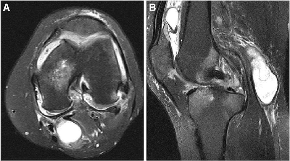 Mastering Baker's Cyst: A Comprehensive Guide by Knee Surgery Specialist