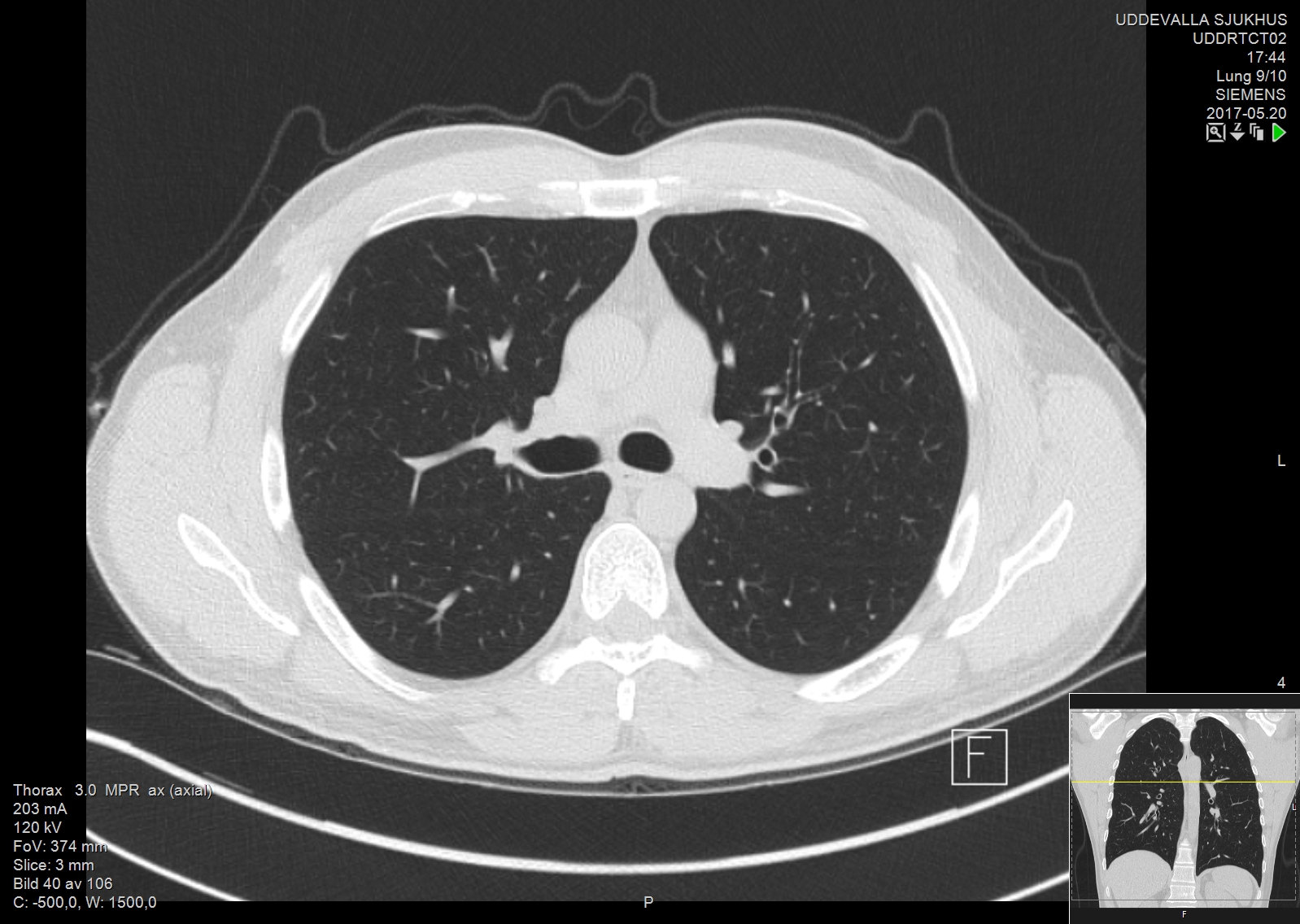 Labeled White Cell Scan (Tc99 or Gallium67) | The Spine Institute ...