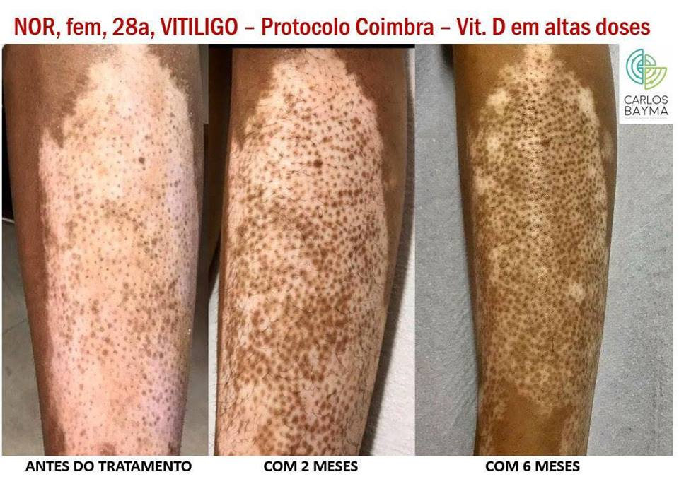 Dr. Carlos Bayma - Vitiligo