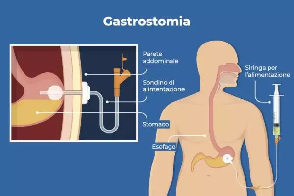 Gastrostomia Endoscopica Percutanea (PEG)