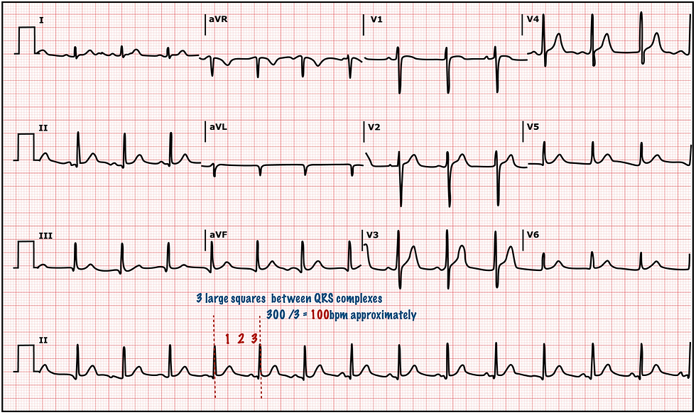 Basic 6 Step Rhythm Interpretation | EXG