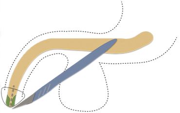 Meatoplasty / Meatotomy / Transmeatal Ureathroplasty | Dr. Sean Elliott