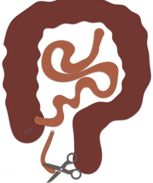 Mitrofanoff and Monti: Illustrated Description of Surgery | Dr. Sean ...