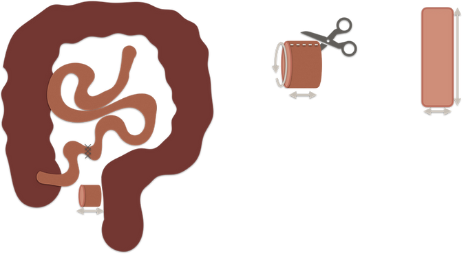 Mitrofanoff and Monti: Illustrated Description of Surgery | Dr. Sean ...