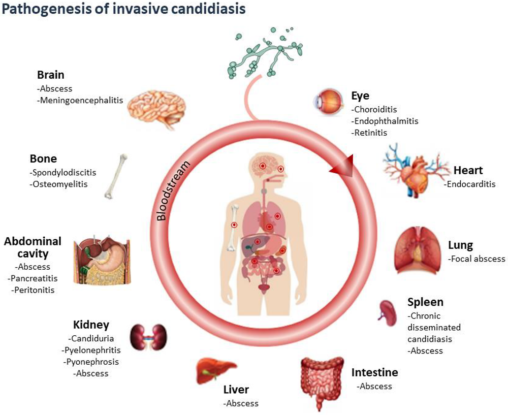 Prevention is the best method of avoiding Systemic Candidiasis.