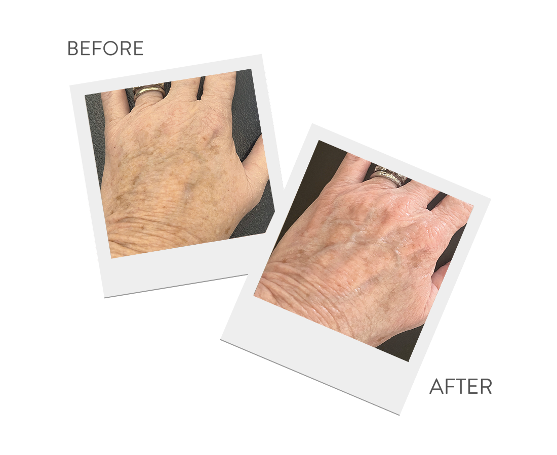 Undo the Sun—Reveal Your Best Skin with Solaria CO2 Laser for Sun ...