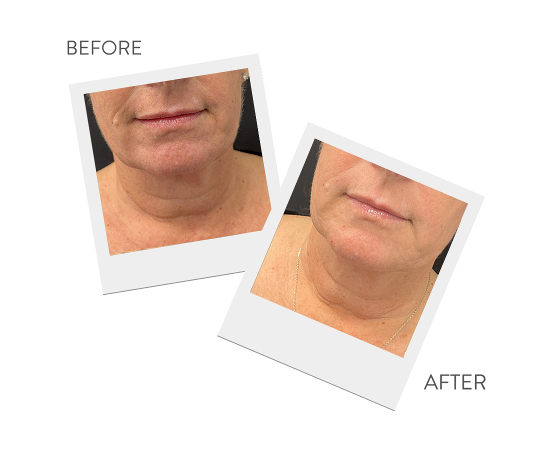 Undo the Sun—Reveal Your Best Skin with Solaria CO2 Laser for Sun ...