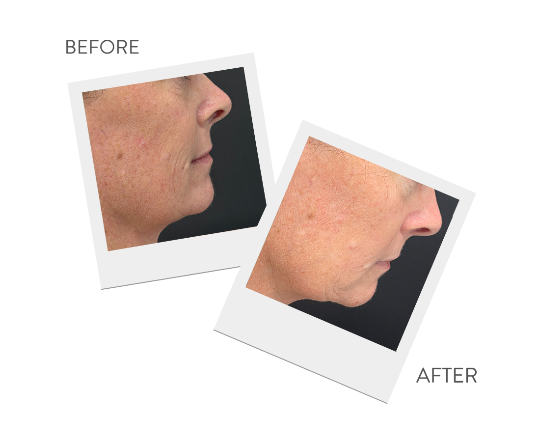 Undo the Sun—Reveal Your Best Skin with Solaria CO2 Laser for Sun ...