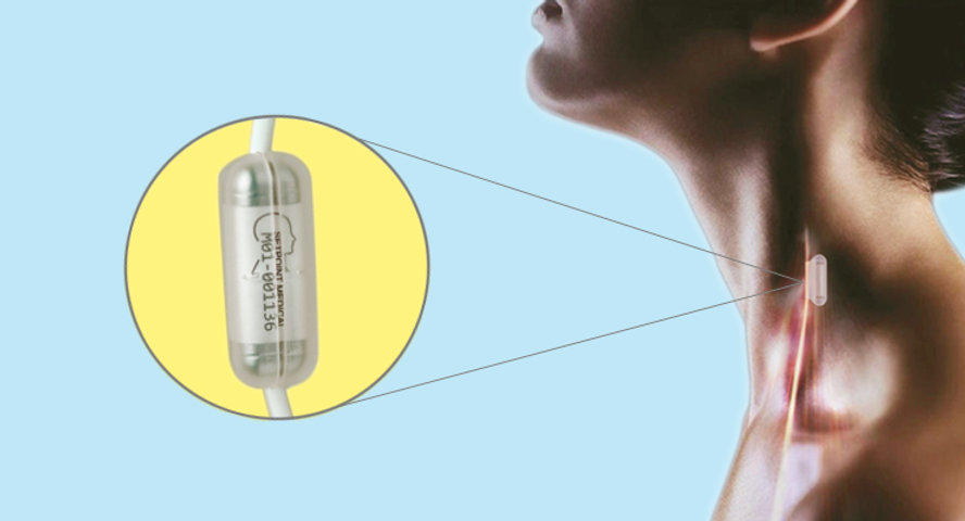 PRESS RELEASE: Austin Neurosurgeons Performs First Vagus Nerve Implant ...