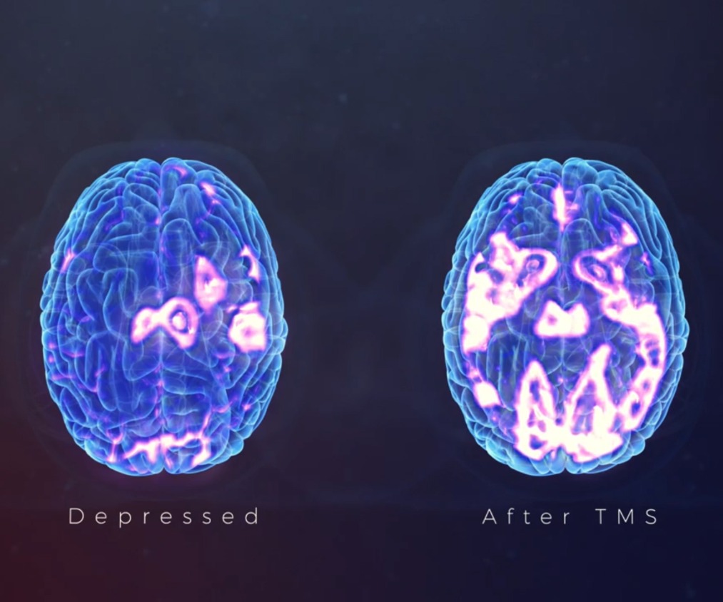 The Neuro Clinic | TMS
