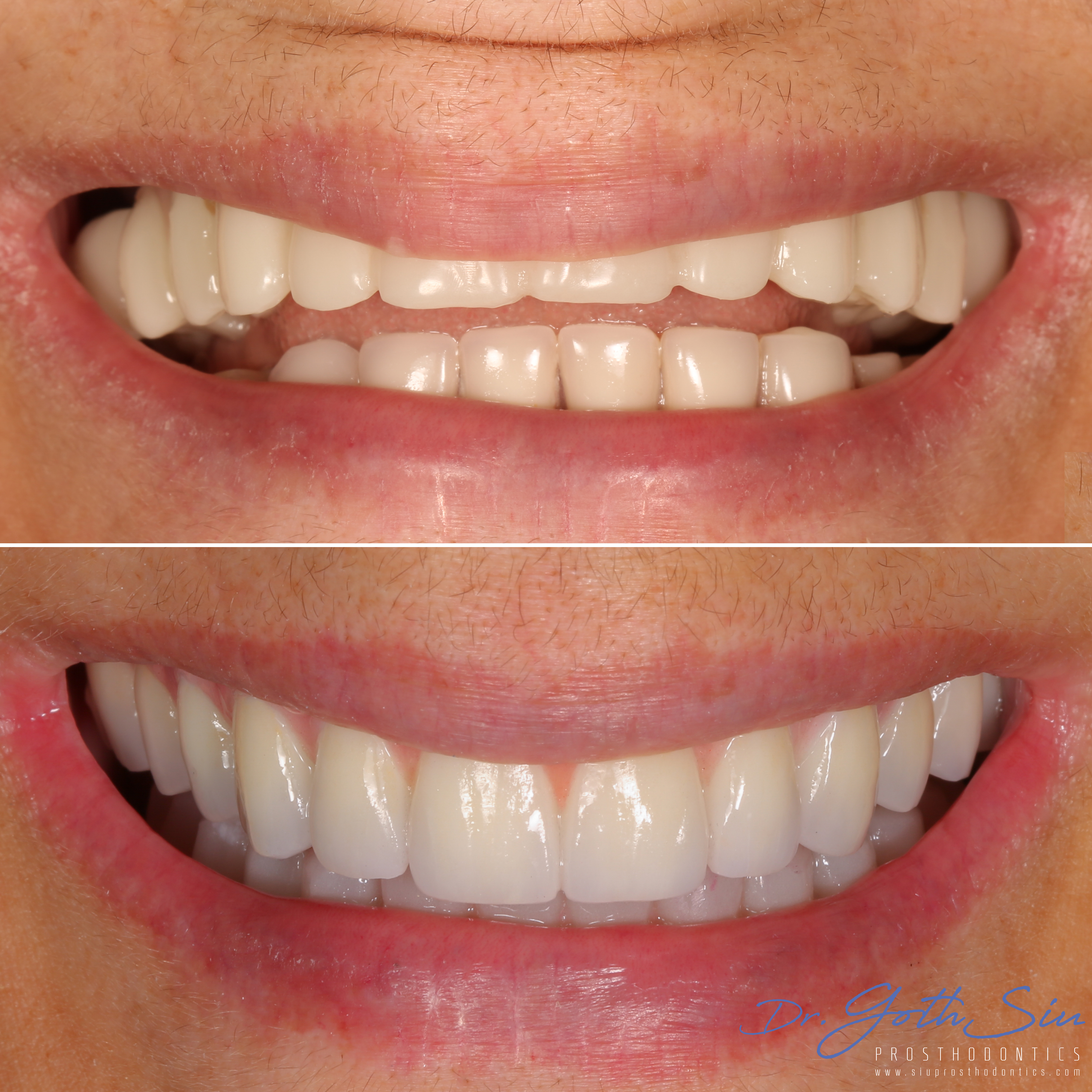 Smile Aesthetics Yorkville Prosthodontics | Dr. Goth Siu | Toronto