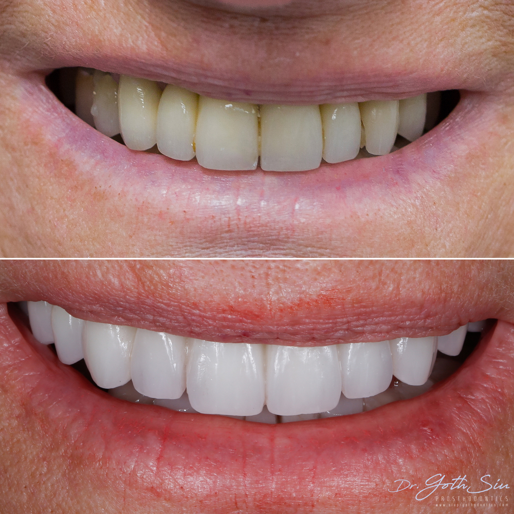 Smile Aesthetics Yorkville Prosthodontics | Dr. Goth Siu | Toronto