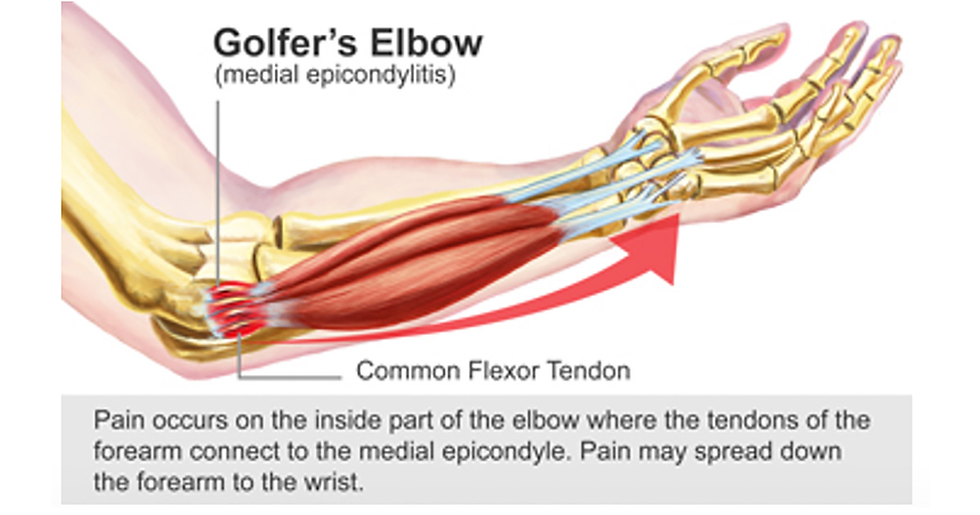 Drive Away Elbow Pain: The Benefits of Physiotherapy for Golfer's Elbow