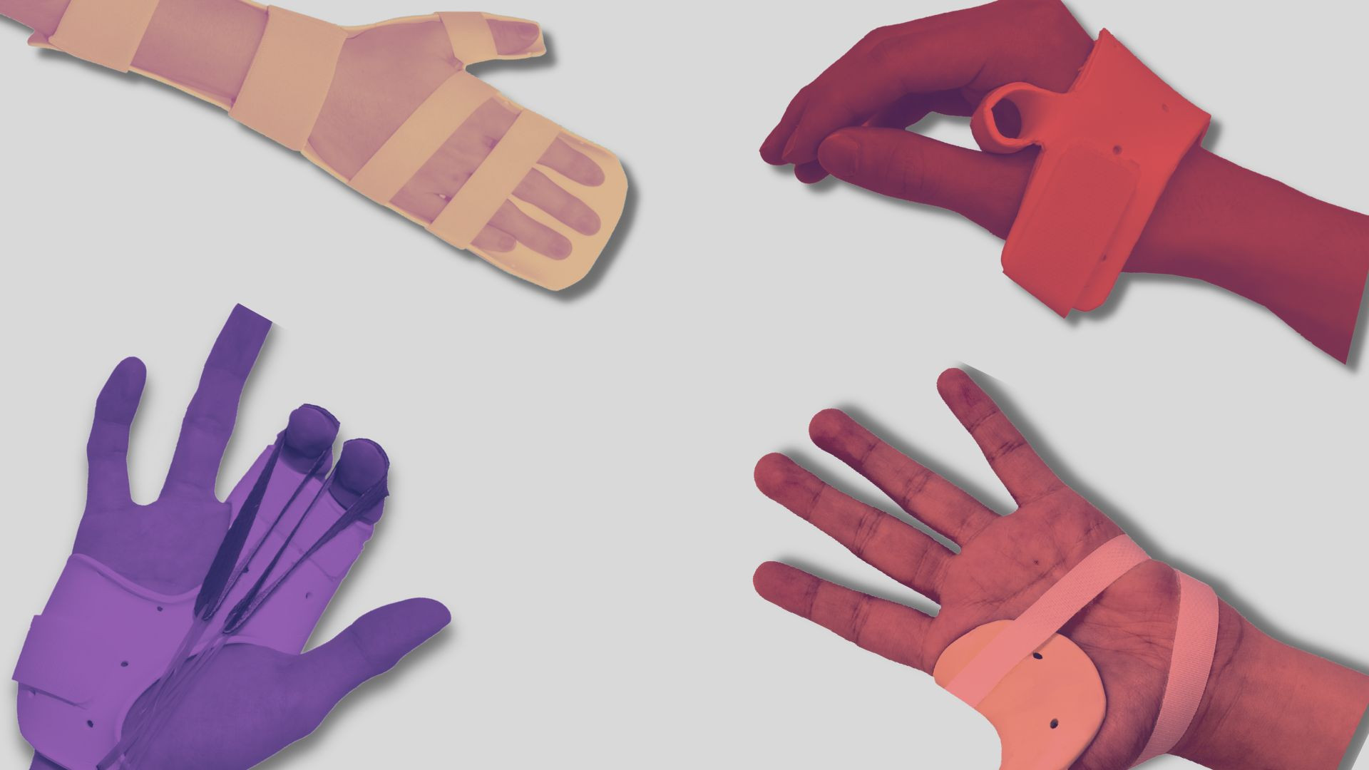 Application of Splinting in Rehabilitation of the Burned Hand