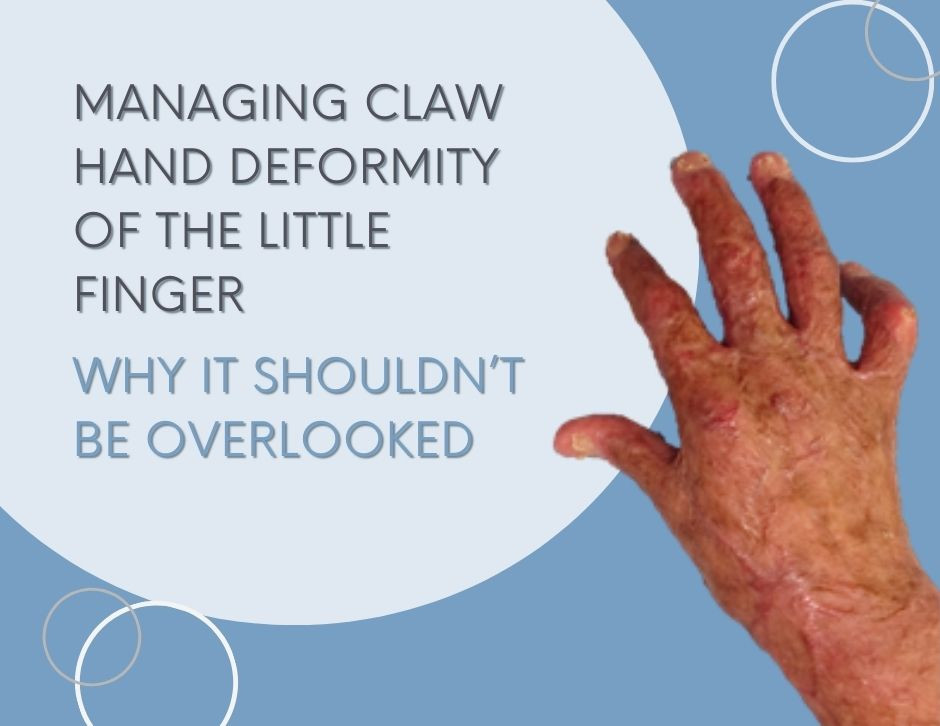 Managing little finger claw hand deformity: Why it shouldn’t be overlooked