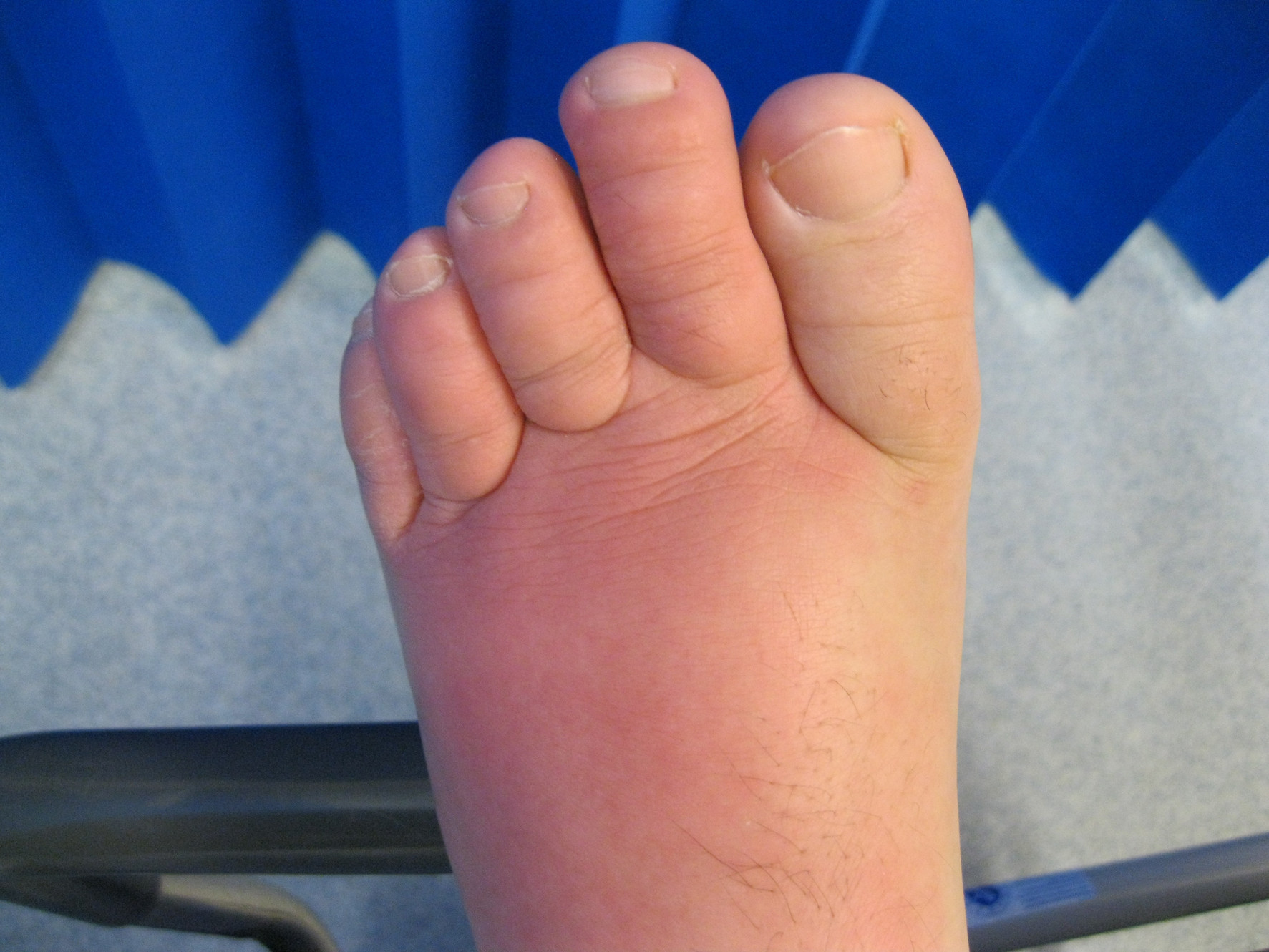 New Tool Indicates When IV Antibiotics Are Needed For Cellulitis In Ch New Tool Indicates When IV Antibiotics Are Needed For Cellulitis In Ch