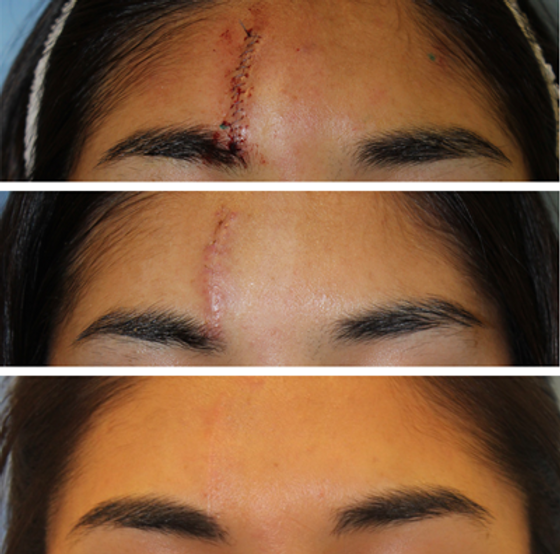 Many patients, doctors disagree about severity of post-surgical scars