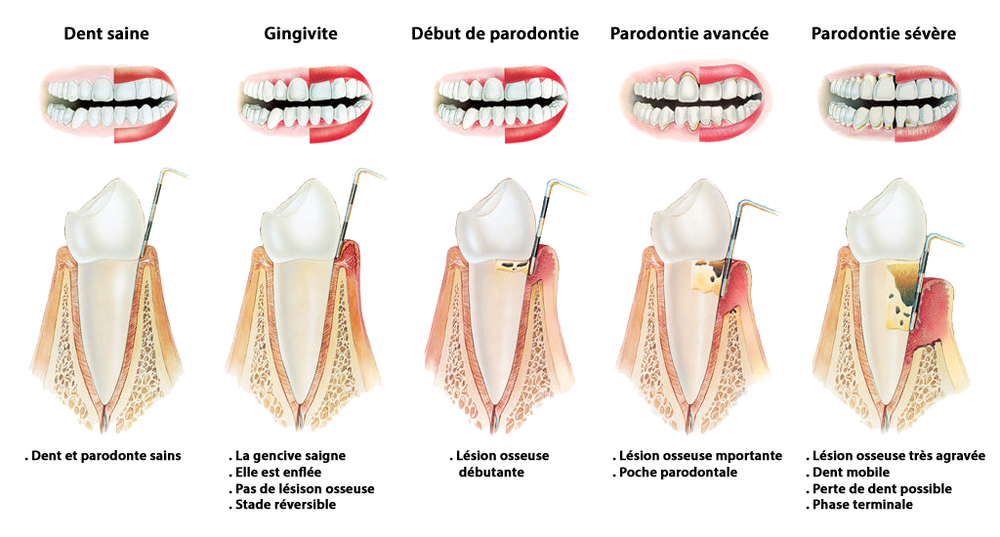 Les soins des gencives