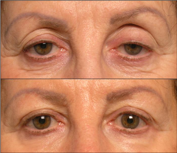 The 3 Types of “Droopy Eyelids”