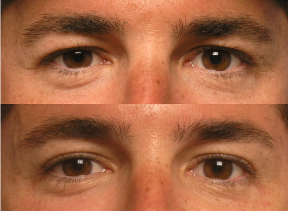 The 3 Types of “Droopy Eyelids”