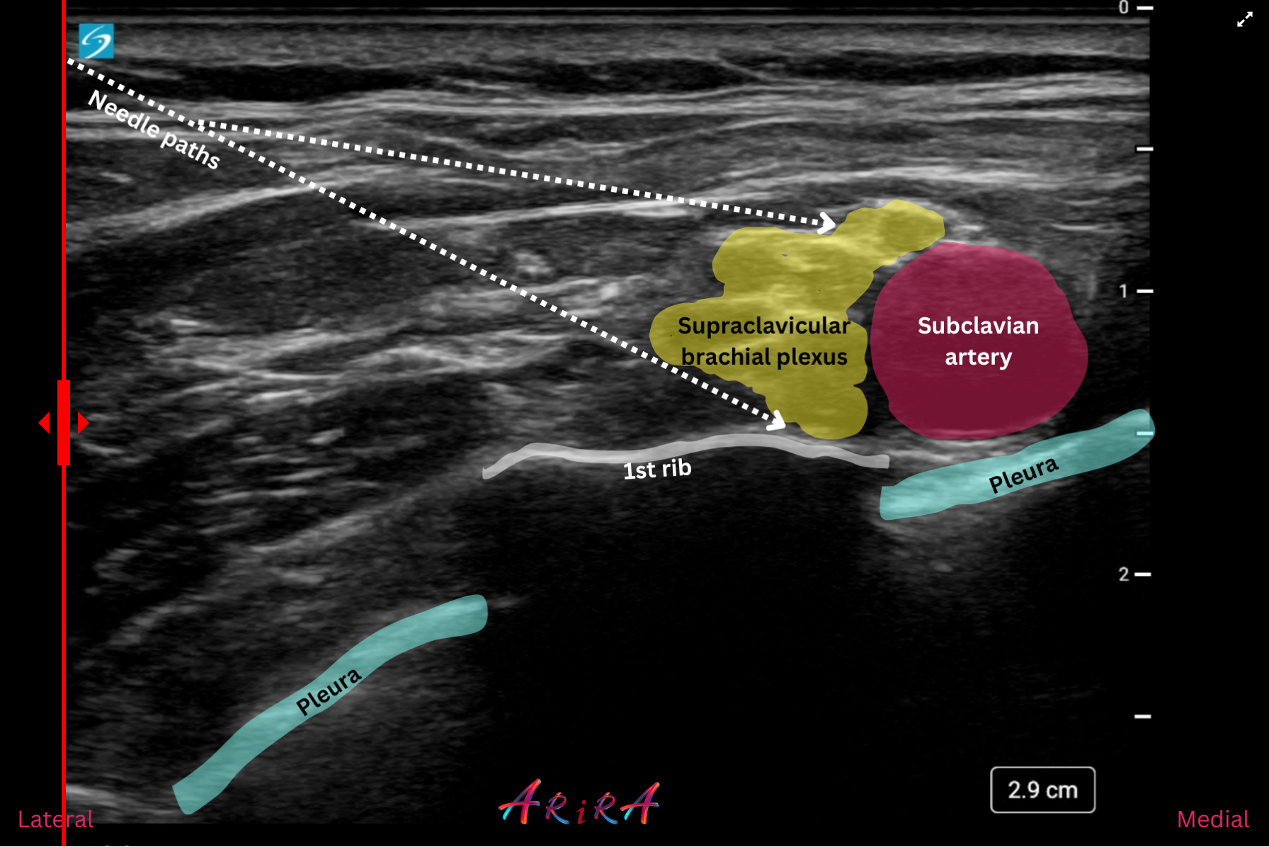 Supraclavicular Brachial Plexus Block