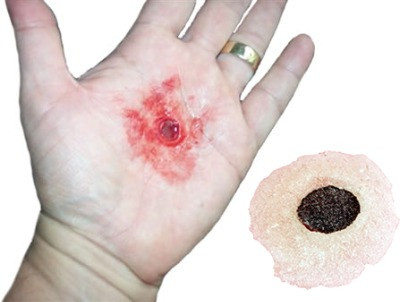 TraumaSFX™ PVA Bullet Entry Wound Appliance | TraumaSFX