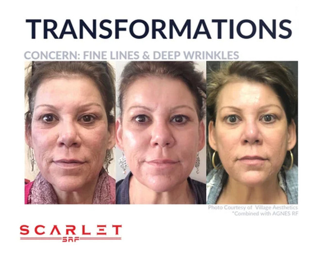 Scarlet SRF & SkinPen Microneedling I Kenosha - Janesville I Skin R.N.