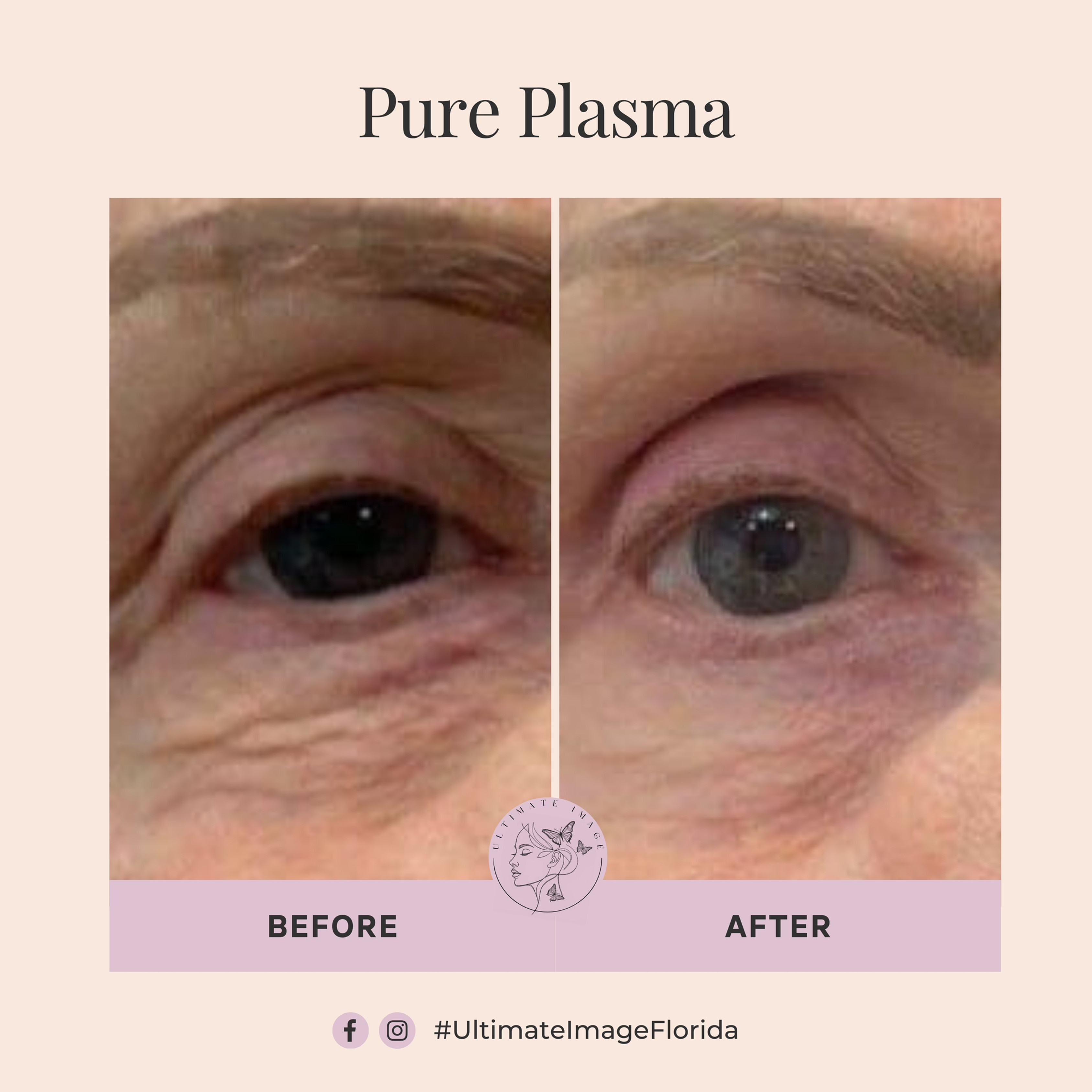 Pure Plasma Skin Rejuvenation | Ultimate Image
