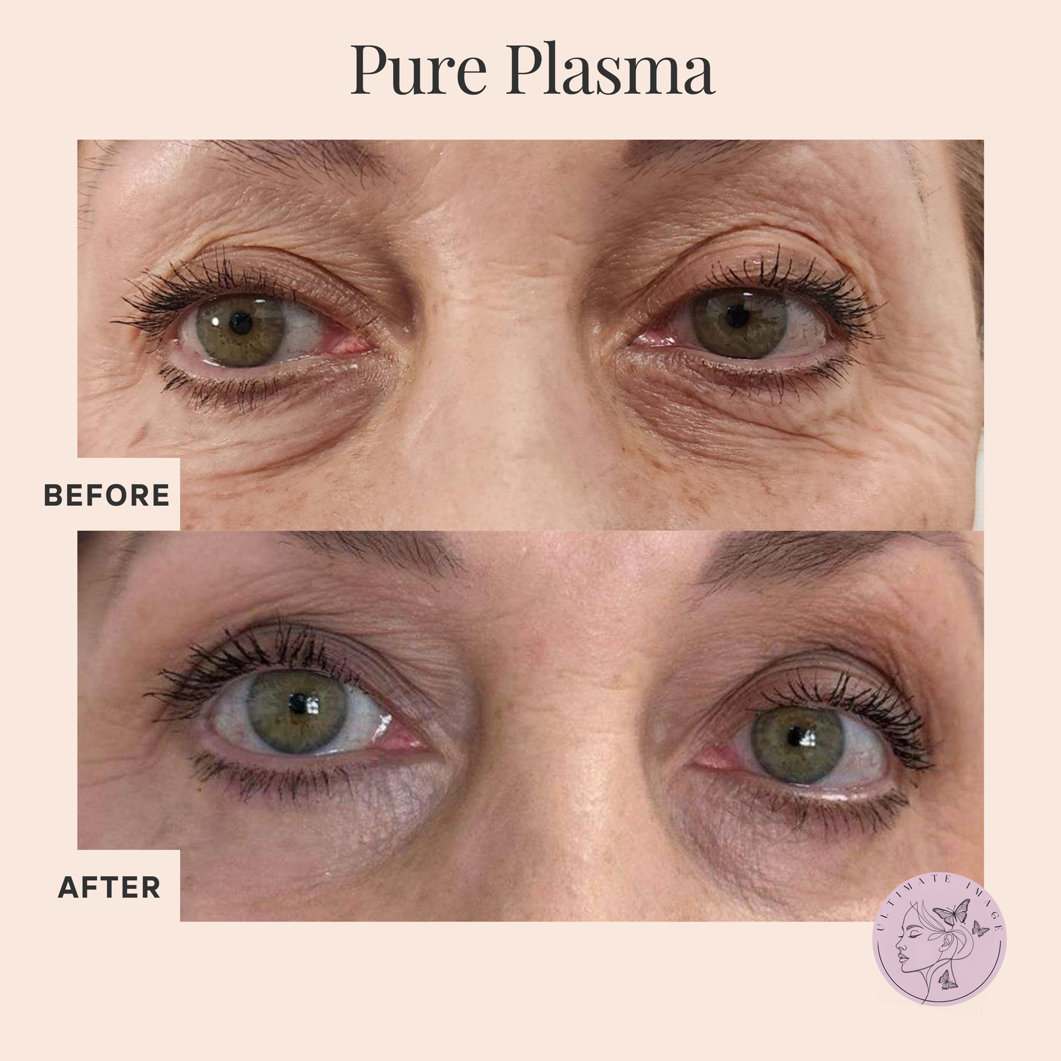 Pure Plasma Skin Rejuvenation | Ultimate Image