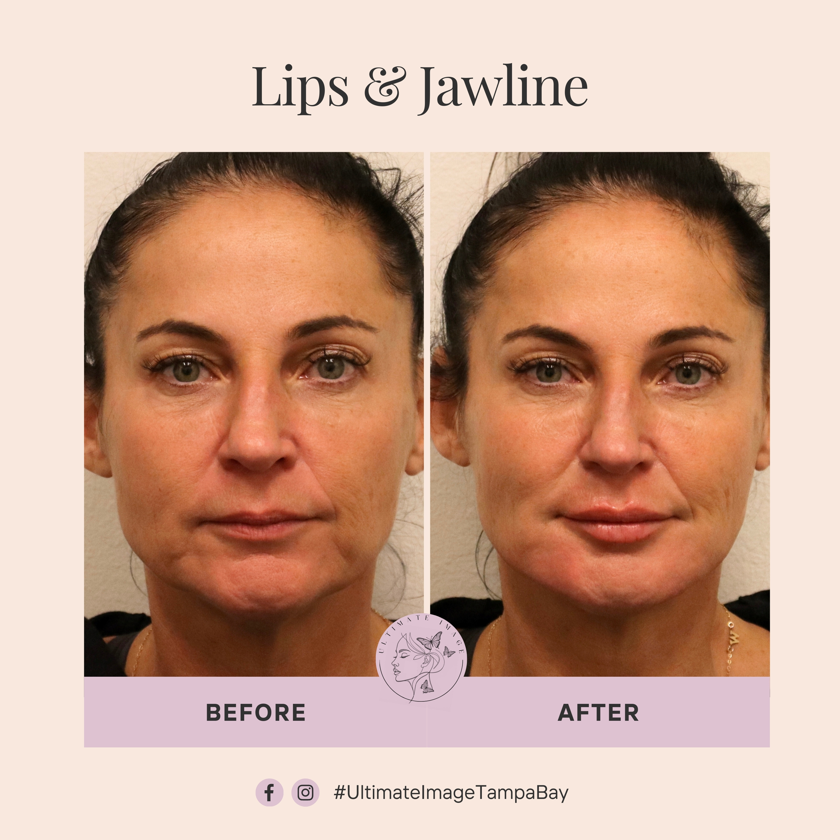 Lower Facial Balancing with Filler | Ultimate Image
