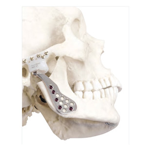 Total Joint Replacement System | Selective Surgical