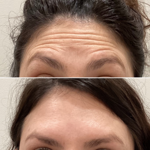 Expert Botox Treatments in Phoenixville, PA | Nakd Aesthetics