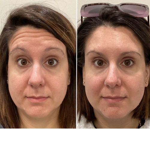 Botox Treatments | Nakd Aesthetics in Phoenixville, PA